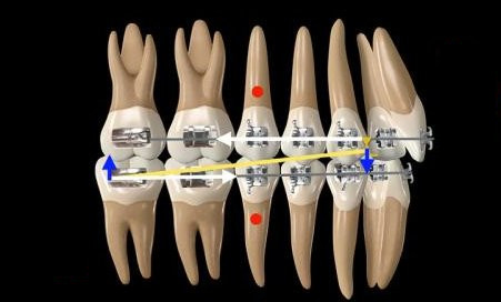 gli elastici in ortodonzia - dott. Gennaro Vittozzi